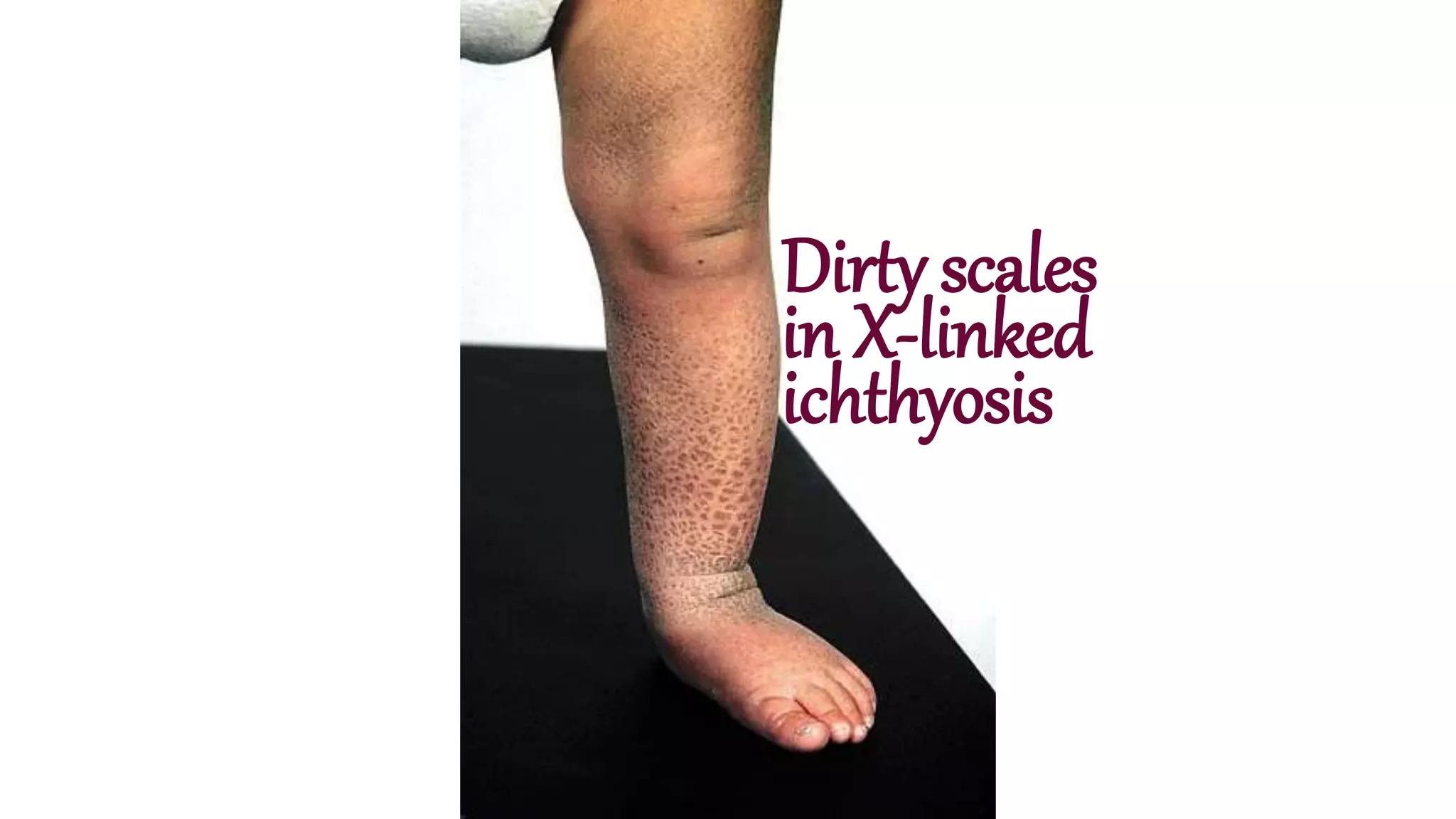 Ichthyoses | PPTX