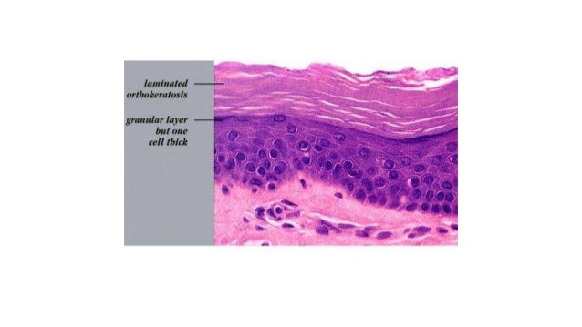 Ichthyosis Vulgaris Histology Acquired Ichthyosis With Systemic Lupus