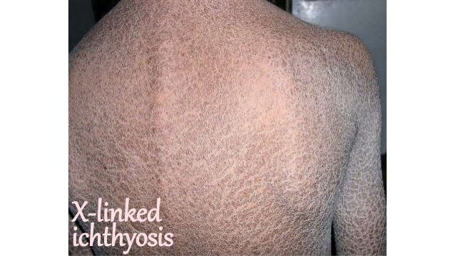 Ichthyoses