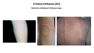Ichthyoses | PPTX