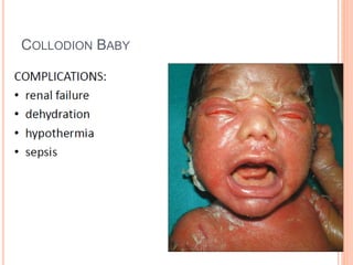 Ichthyoses and ichthyosiform | PPT