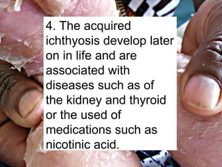 Ichthyosis | PPTX