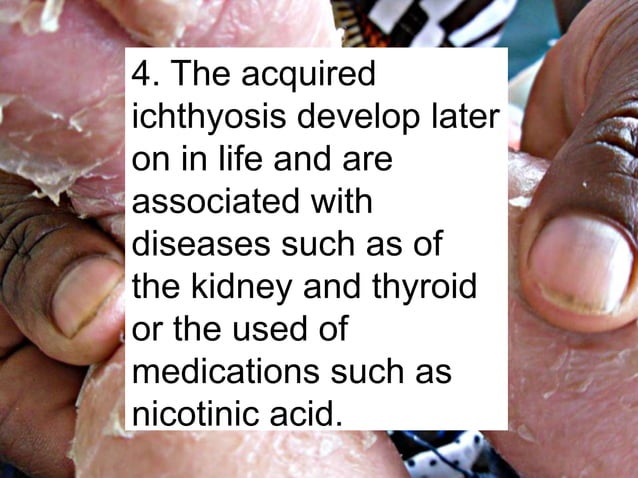 Ichthyosis | PPTX | Skin and Dermatology | Diseases and Conditions