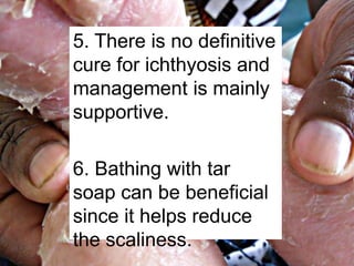 Ichthyosis | PPTX