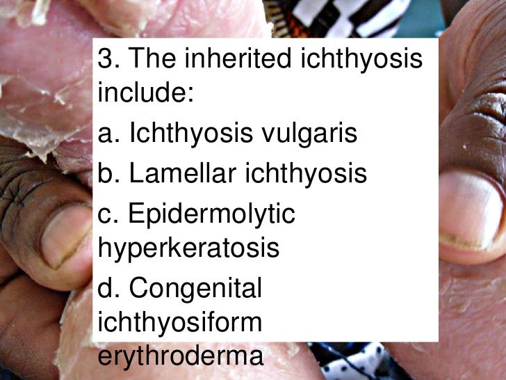 Ichthyosis