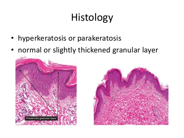 Ichthyosis Vulgaris Histology
