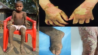Ichthyosis( congenital) | PPTX