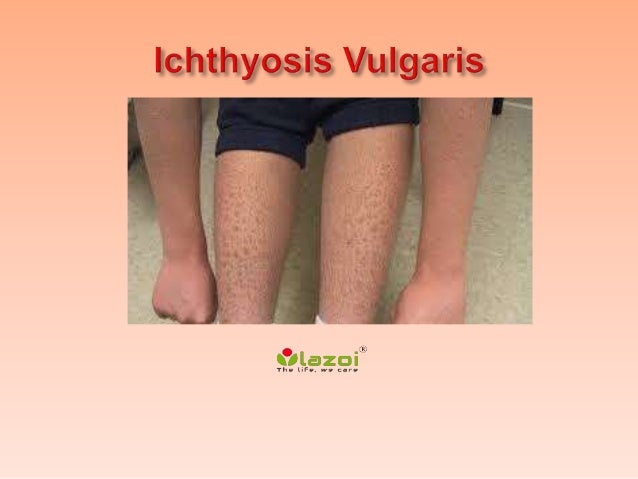 Ichthyosis Vulgaris
