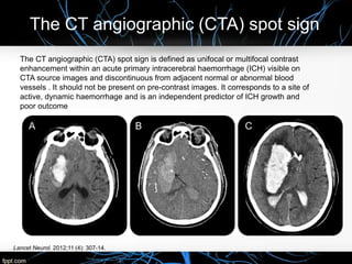 Intracerebral Hemorrhage Case presentation | PPTX