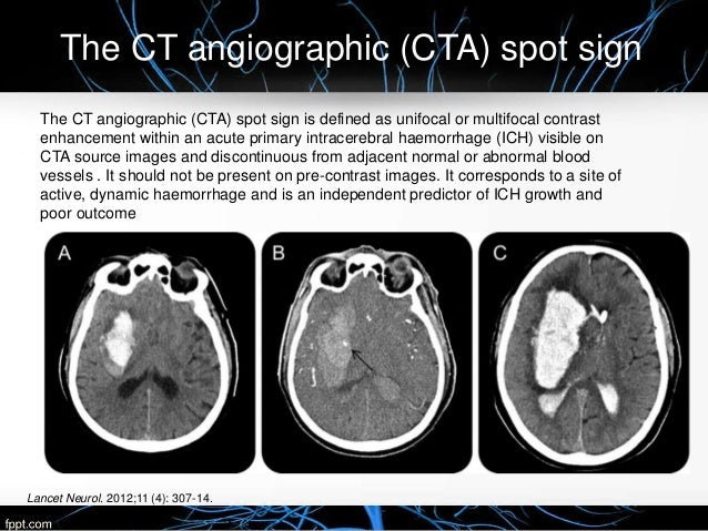 Intracerebral Hemorrhage Case presentation