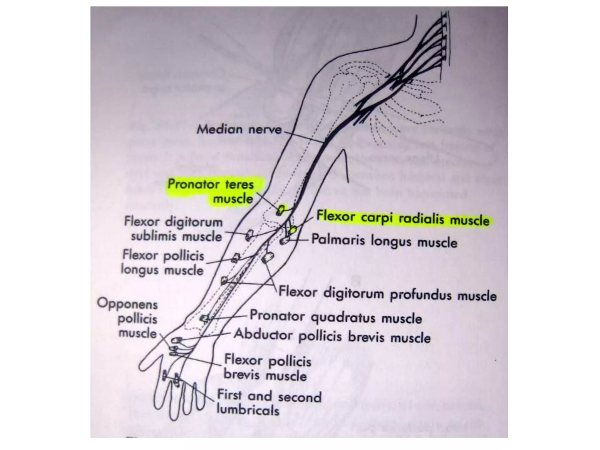 Icl 2008 02 median nerve compression about the elbow | PPT
