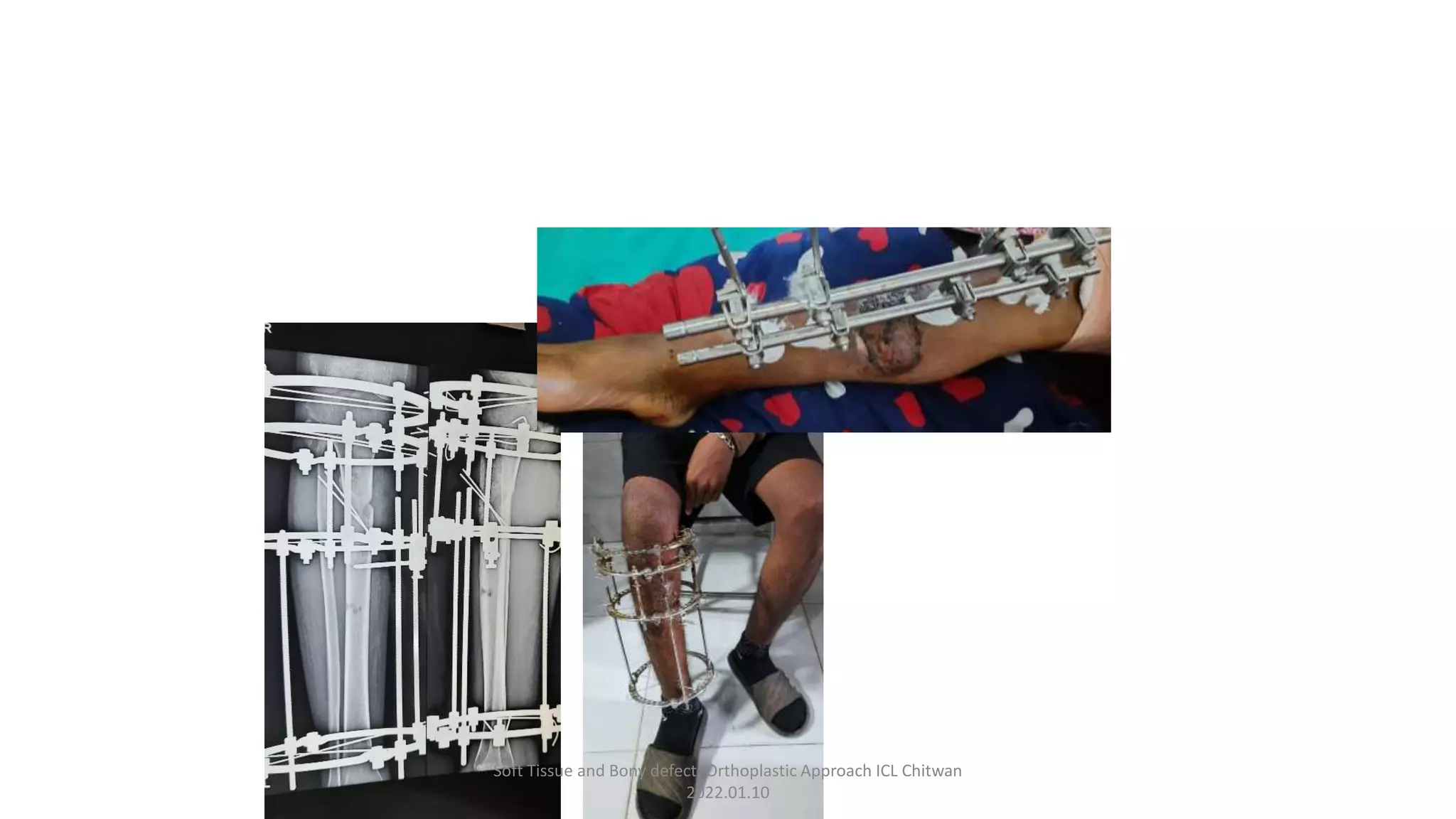 ICL orthocon 2022 Soft Tissue Reconstruction Lower Limb.pptx