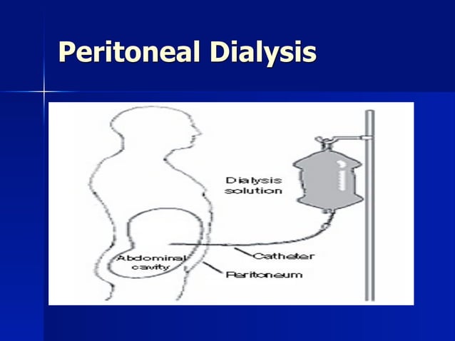Icm peritoneal dialysis 23 4 | KEY