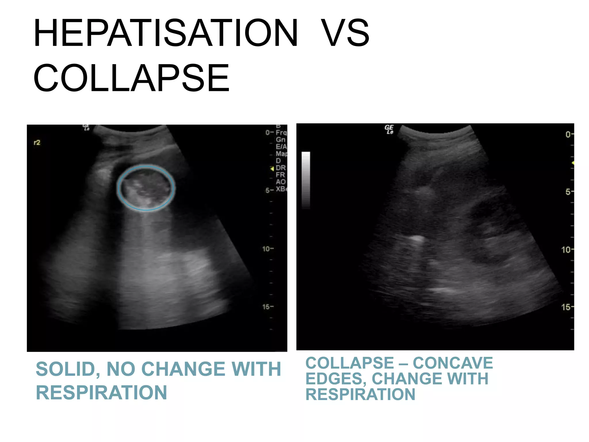 The Basics of Lung Ultrasound | PPTX