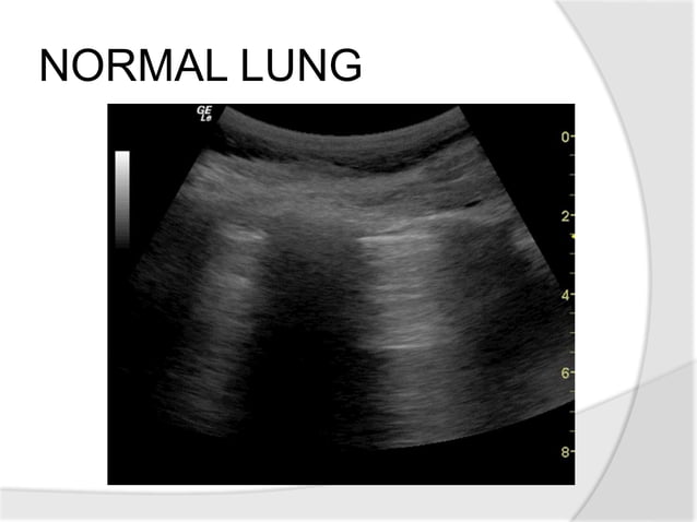 The Basics of Lung Ultrasound | PPTX