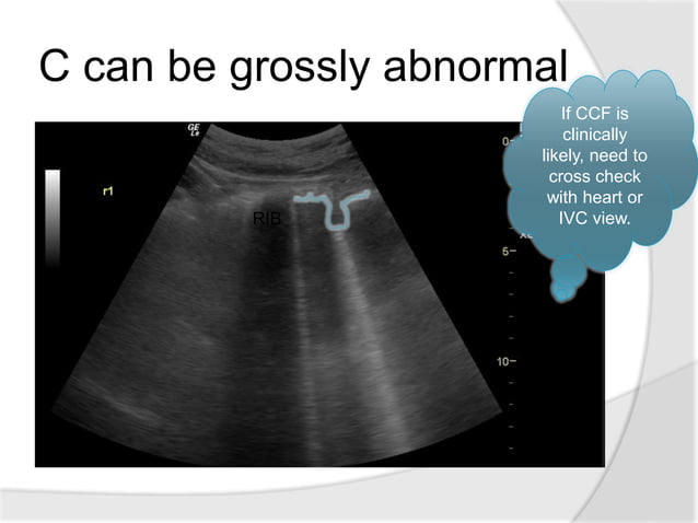 The Basics of Lung Ultrasound | PPTX