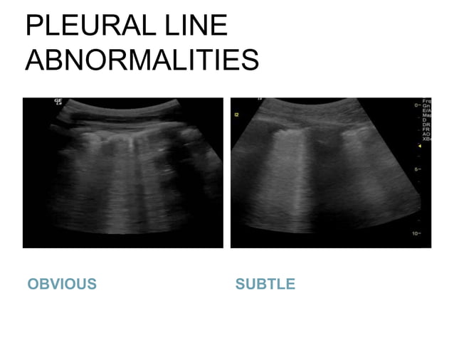The Basics of Lung Ultrasound | PPTX