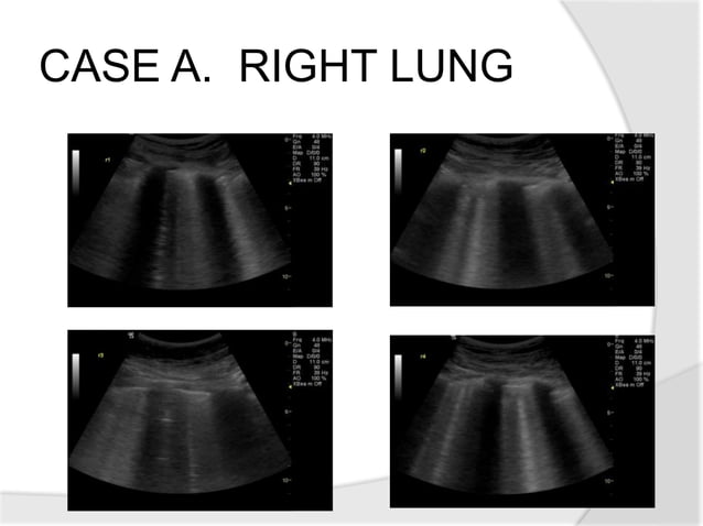 The Basics of Lung Ultrasound | PPTX