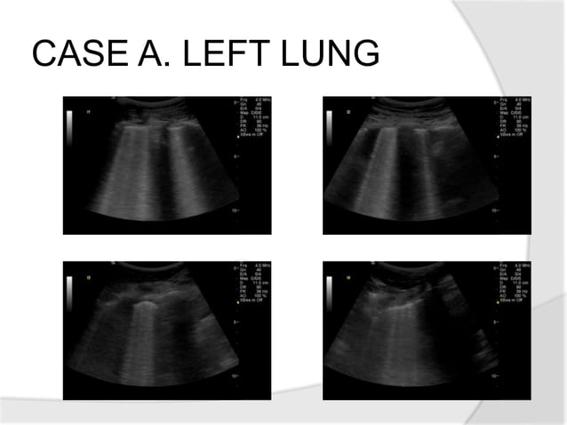The Basics of Lung Ultrasound | PPTX