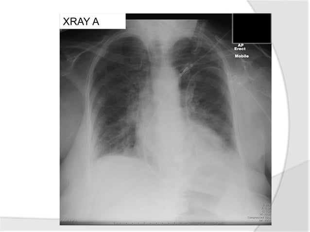 The Basics of Lung Ultrasound | PPTX