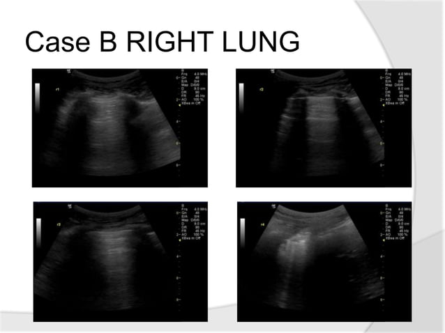 The Basics of Lung Ultrasound | PPTX