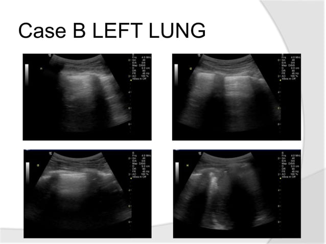 The Basics of Lung Ultrasound | PPTX