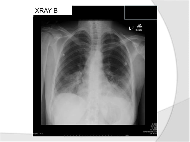 The Basics of Lung Ultrasound | PPTX