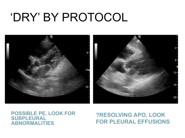 The Basics of Lung Ultrasound | PPTX