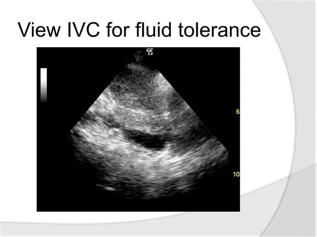 The Basics of Lung Ultrasound | PPTX