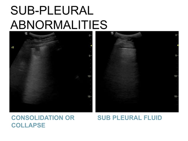 The Basics of Lung Ultrasound | PPTX