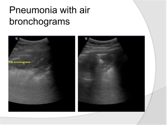 The Basics of Lung Ultrasound | PPTX