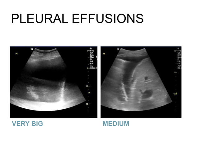 The Basics of Lung Ultrasound | PPTX