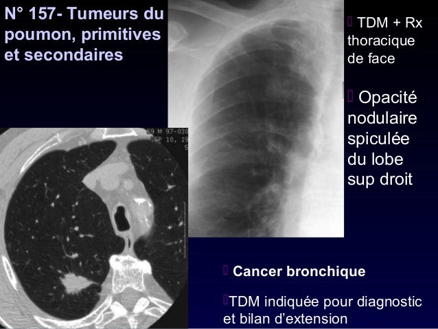 Quels Sont Les Symptômes Du Tdm Thoracique – JRYE