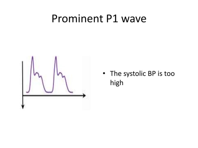 Intracranial pressure - waveforms and monitoring | PPSX