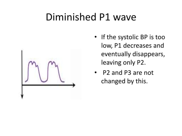Intracranial pressure - waveforms and monitoring | PPT