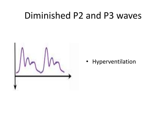 Intracranial pressure - waveforms and monitoring | PPSX