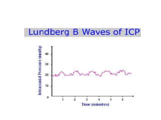 Intracranial pressure - waveforms and monitoring | PPSX