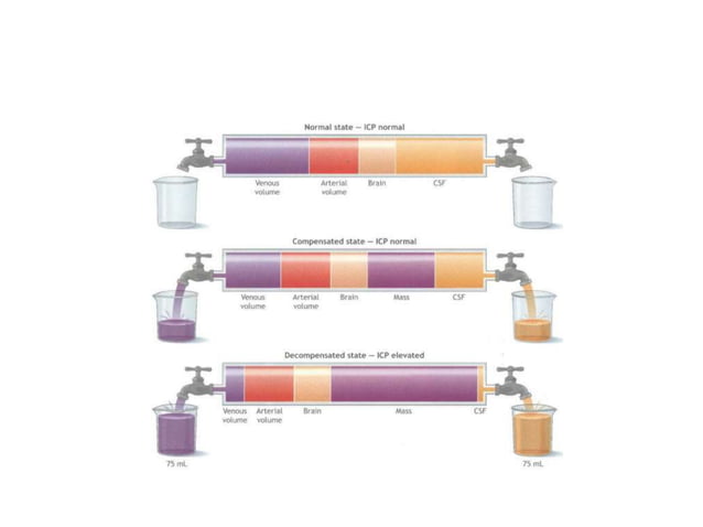 Intracranial pressure - waveforms and monitoring | PPSX