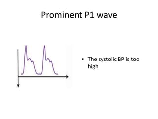 Intracranial Pressure Waveform