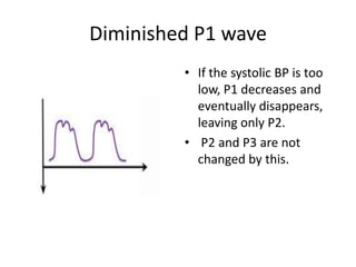Icp Waveforms Abc Waves