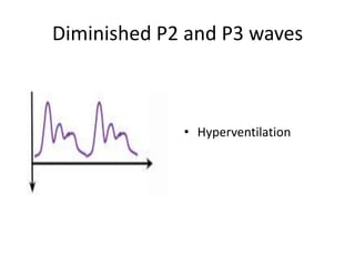 Intracranial Pressure Waveform