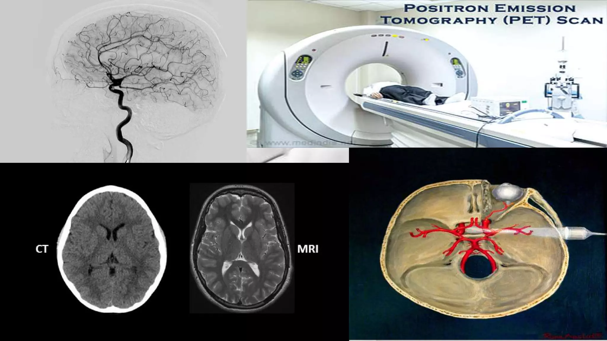 Increased intracranial pressure | PPTX