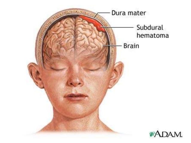 PathoPhysiology of Intra cranial pressure.pptx