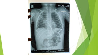 ICP.pptx regarding management of raised IcP | PPTX