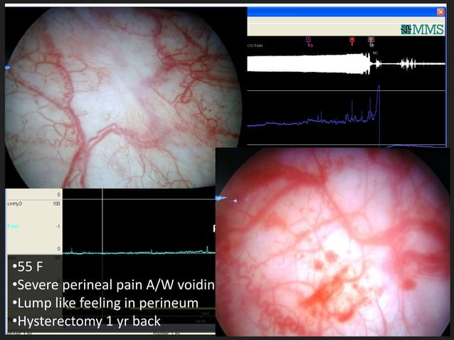 bladder pain syndrome / interstitial cystitis | PPTX