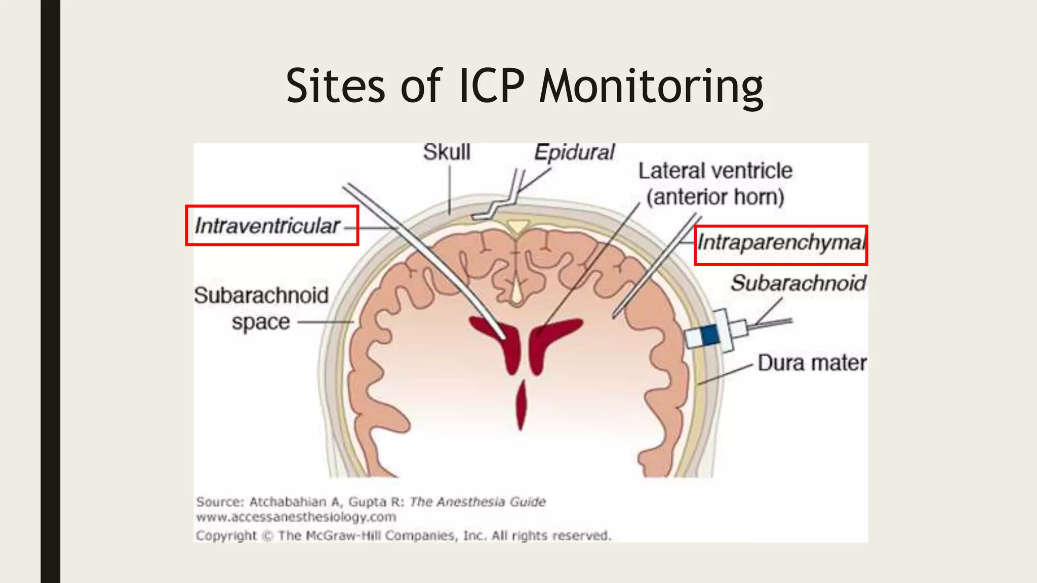 ICP control and CSF drainage - Final.pptx | Death, Injury, or Military ...
