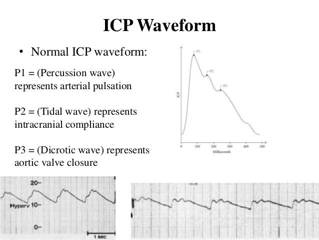 Icp monitoring seminar