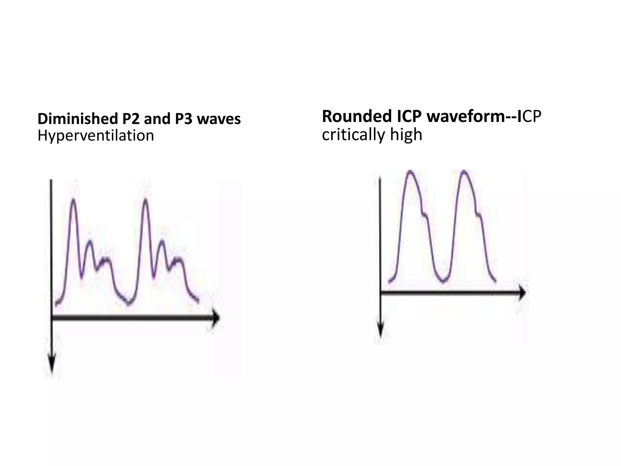 intracranial pressure monitoring | PPTX