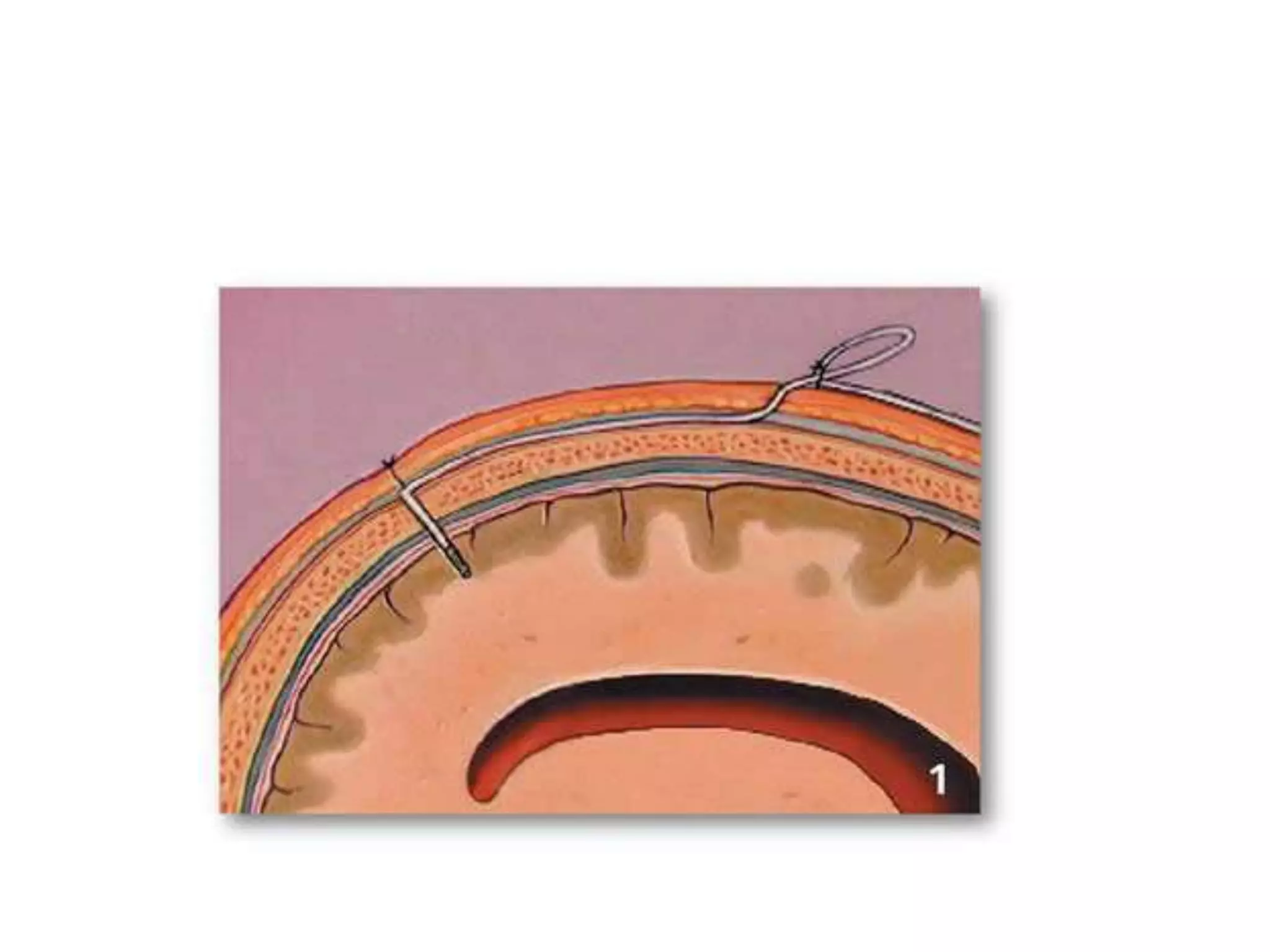 intracranial pressure monitoring | PPTX