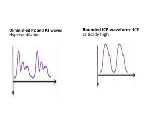 intracranial pressure monitoring | PPTX